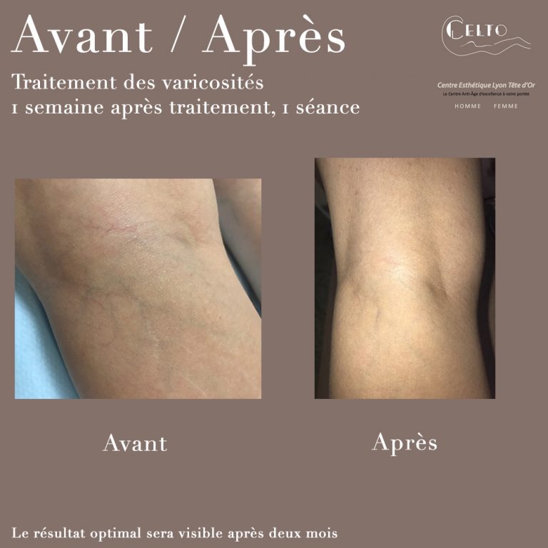 Traitement laser couperose Lyon, traitement angiome, taches ...